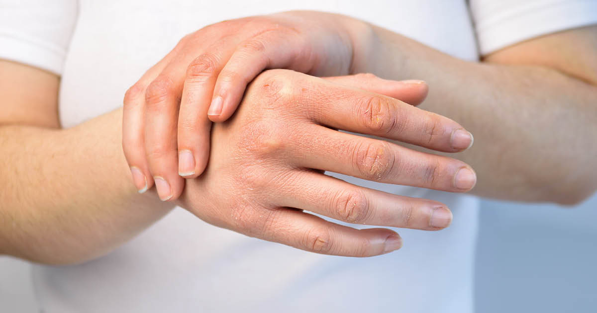 Fischschuppenkrankheit (Ichthyosis) – Entstehung & Behand