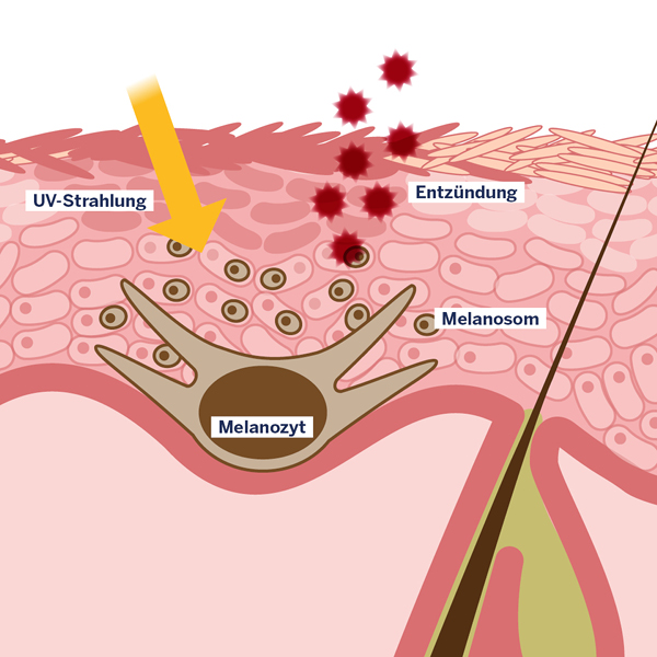 Pickelmale: Was kann ich gegen Hyperpigmentierungen tun?