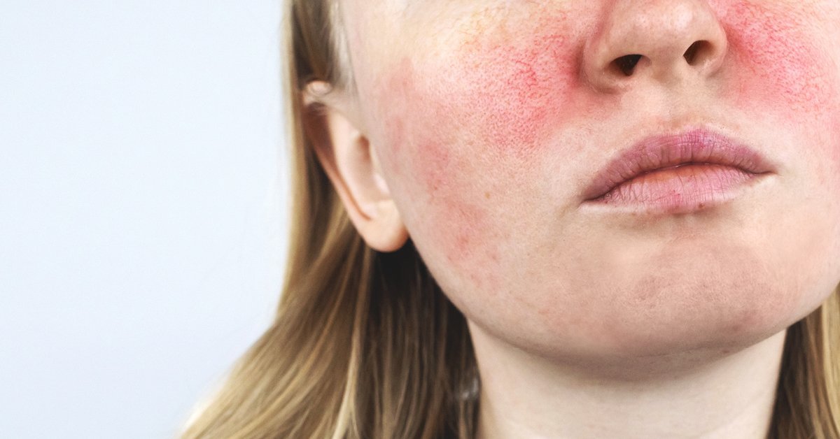 Rosacea-Mythen im Check – Was stimmt wirklich?