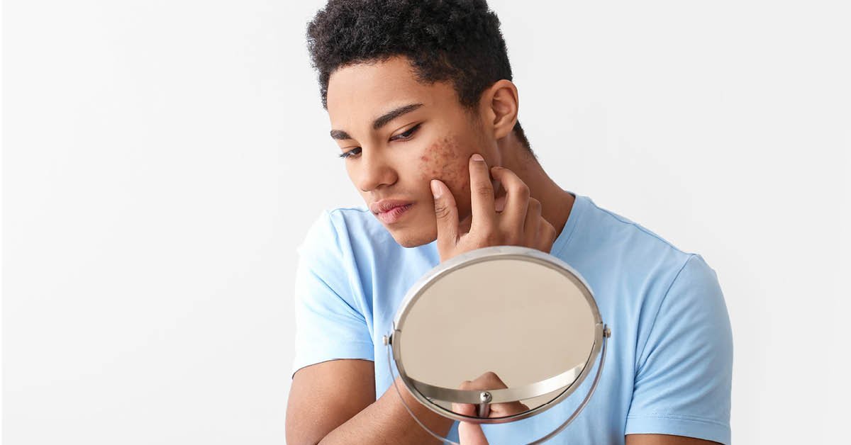 Dermatologische Aknebehandlungen auf dem Prüfstand