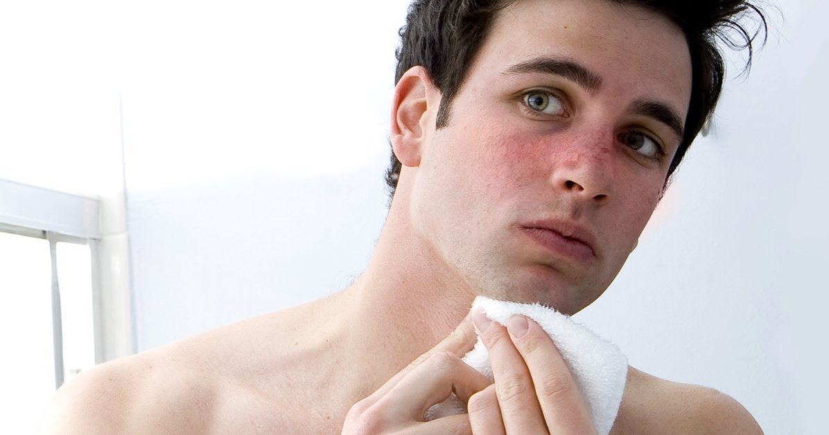 Rosacea op de neus | Wat je moet weten over rhinophyma