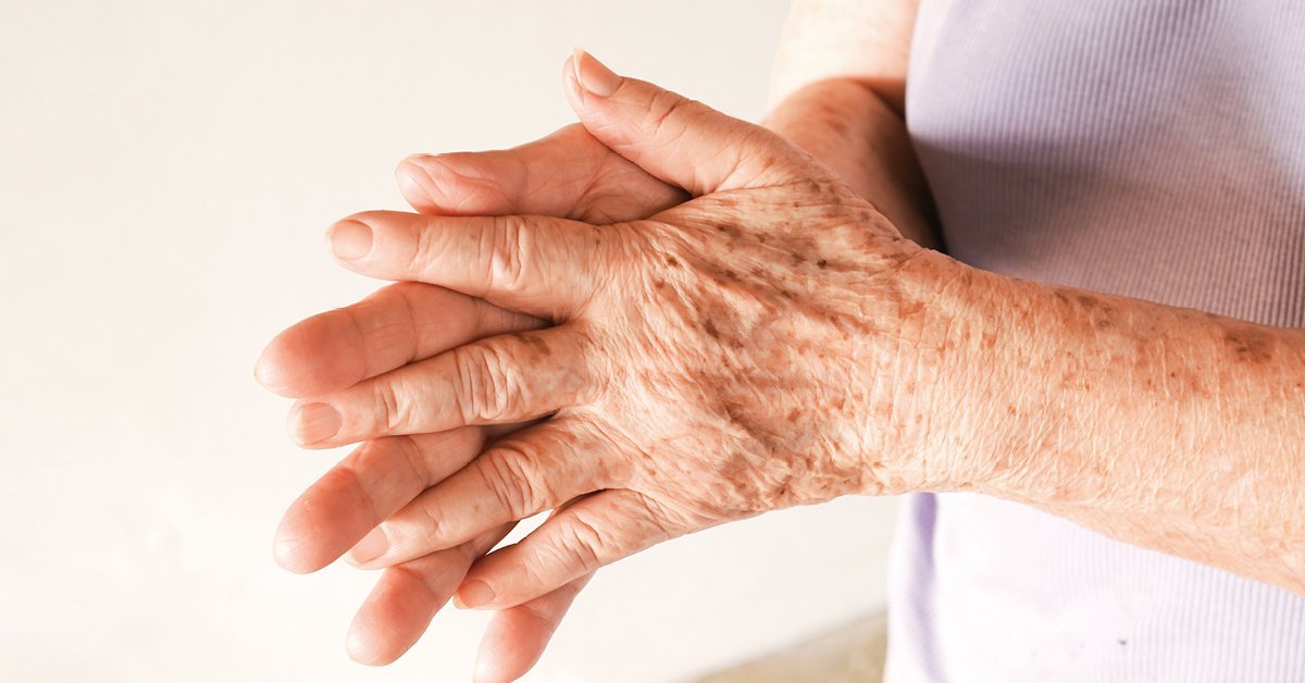 Altersflecken – Ursachen und Hilfe