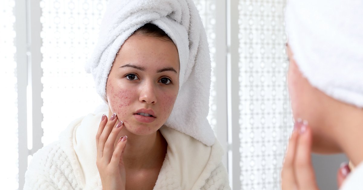 Aknenarben – Entstehung und Behandlung