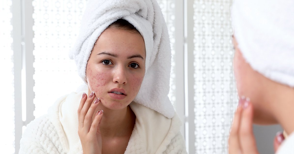 Acne littekens – Ontstaan en behandeling